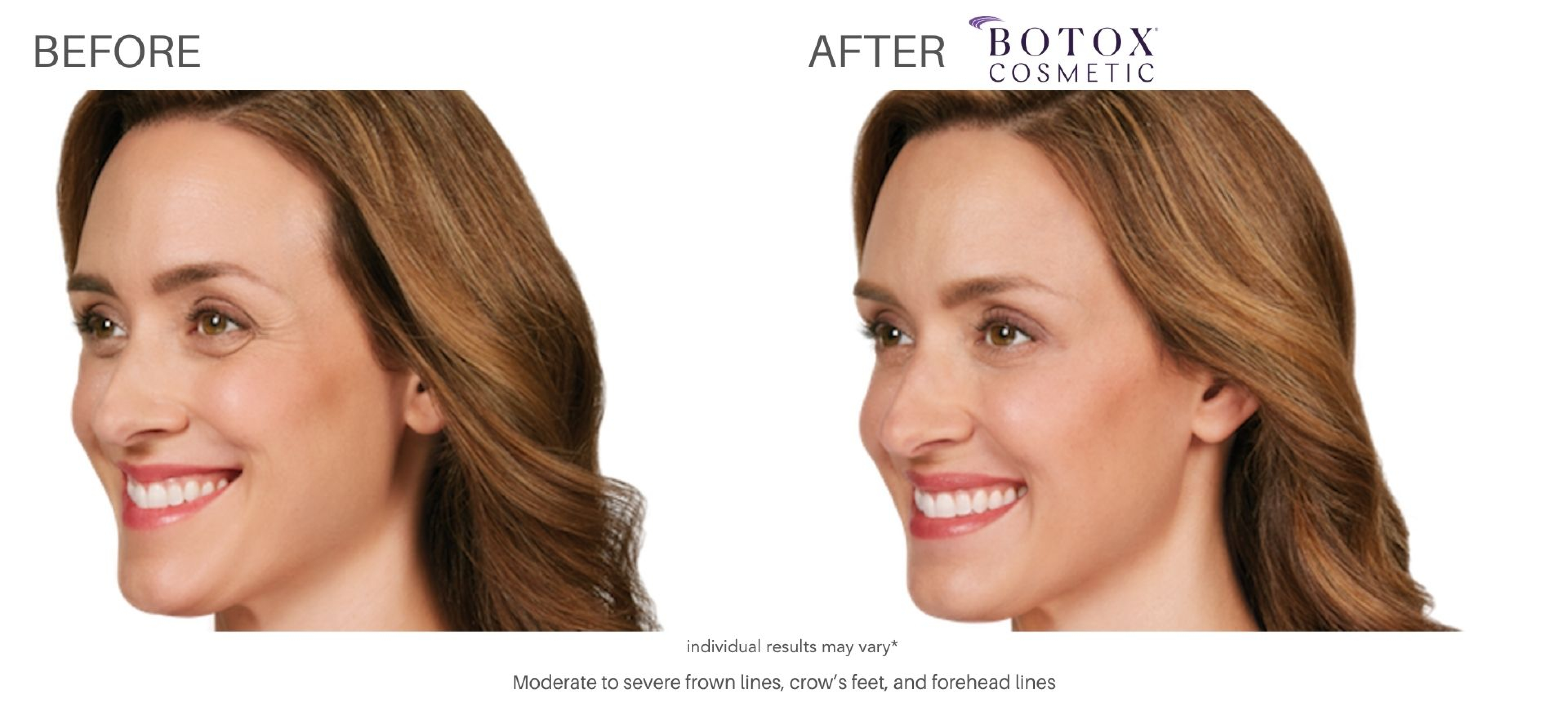 Botox Before and After | Real Results from Real Patients
