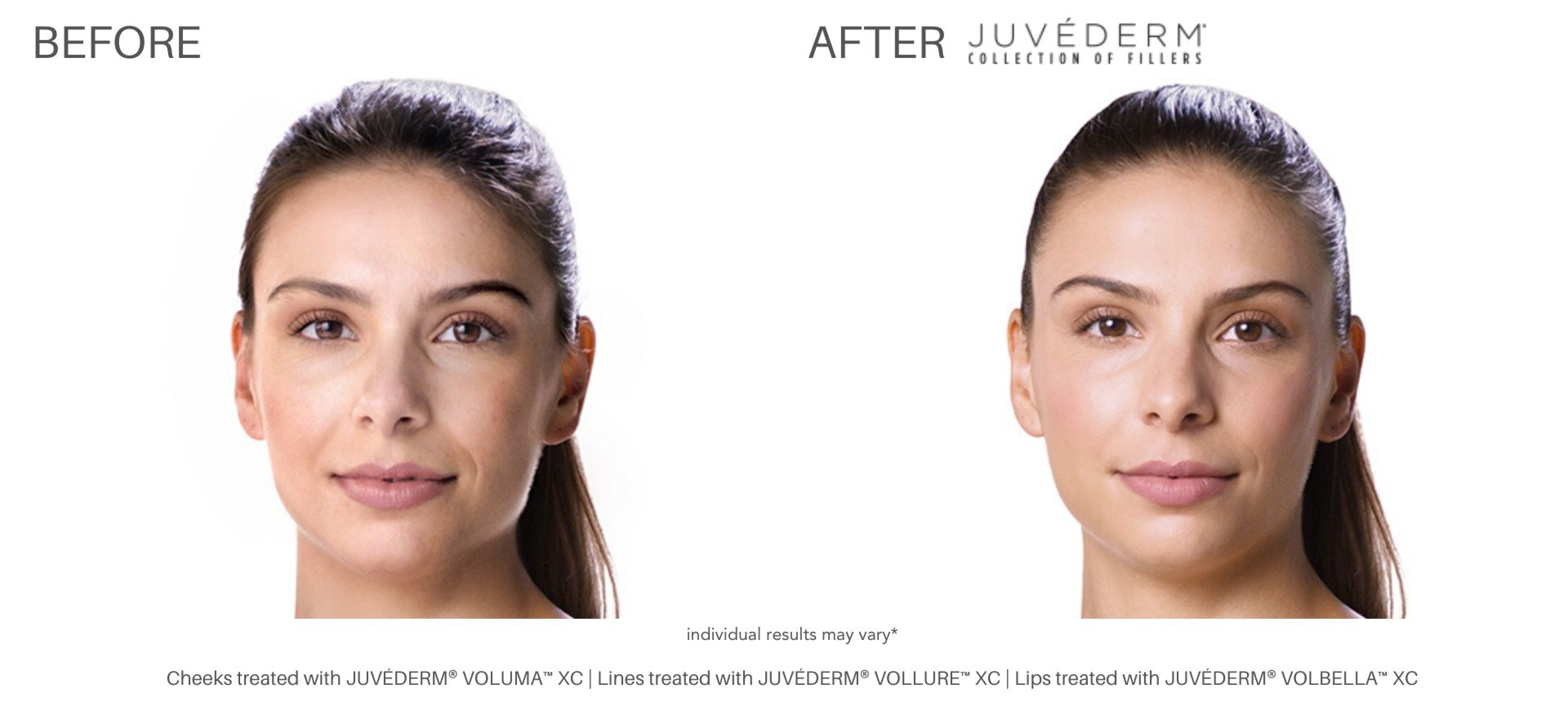 Juvéderm Before and After | Real Patient Results Newport News, VA